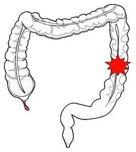 Colonoscopy Dangers Everyone Needs To Be Aware Of - Cancer Wisdom
